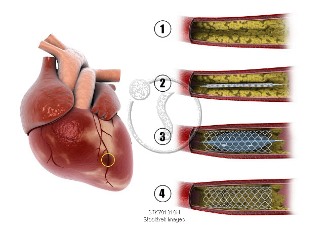 Diagram showing procedure of balloon angioplasty to widen obstructed ...